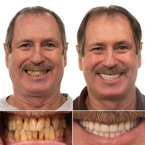 Transformations Atl Dental Implants