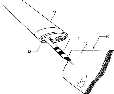 Intraluminal Tissue Markers Eureka Patsnap