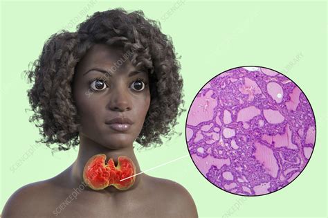 Woman With Enlarged Thyroid And Exophthalmos Illustration Stock Image F043 6089 Science