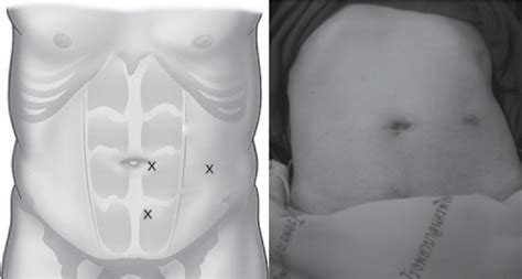 Figure 2 From Laparoscopic Simple Nephrectomy In A Pelvic Ectopic