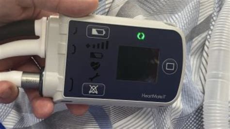 Какво представлява изкуственото сърце къде се поставя и за кои пациенти е подходящо От деня