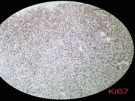 母细胞性浆细胞样树突细胞肿瘤 资讯频道 华夏病理网