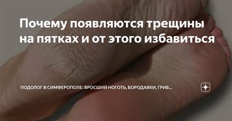Почему появляются трещины на пятках и от этого избавиться Подолог в Симферополе вросший