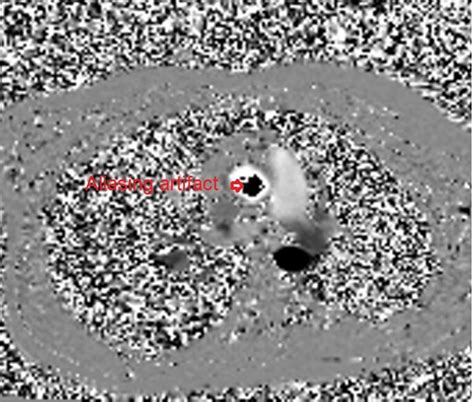 Mri Velocity Encoding Venc Mri
