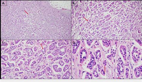 Needle Core Biopsy Of Left Breast Mass A Well Formed Clusters Of