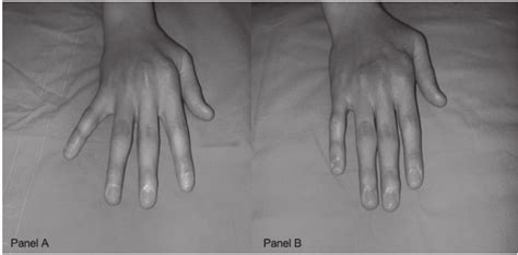 Panel A Ulnar Deviation Of Right Hands Metacarpophalangeal Joints