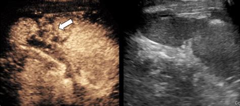 Spleen Injury In A 14 Year Old Girl Who Was An Unrestrained Rear Seat