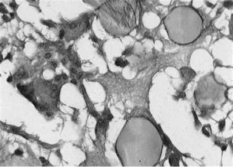 Evolution At 9 Month Macrophages And Multinucleated Giant Cells Have