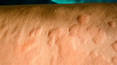 Human Genome Project Types Of Rashes Pictures