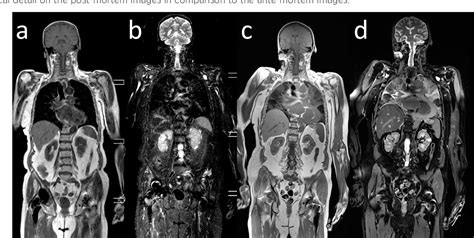 Figure 1 From Essentials Of Forensic Post Mortem Mr Imaging In Adults Semantic Scholar