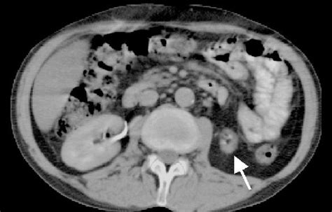 Hypoplasie Du Rein Causes Symptômes Diagnostic Traitement
