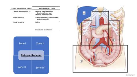 Retrohepatic Ivc Injuries Evaluation And Assessment Pptx