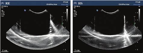 The Ultrasound Images Of A The Reference Phantom And B The Download Scientific Diagram