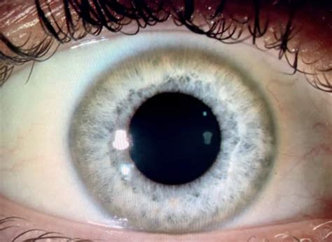 Fleischers Ring Keratoconus