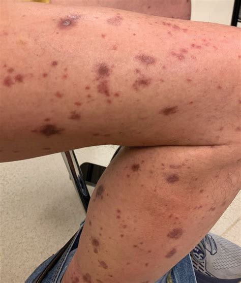 Diffuse Papular Eruption With Erosions And Ulcerations Mdedge