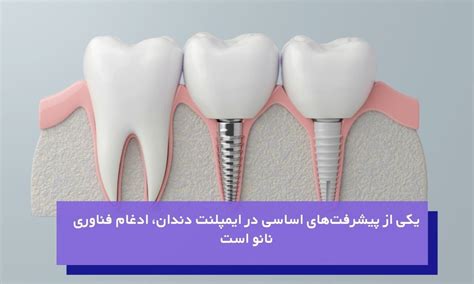 آشنایی با انواع ايمپلنت دندان؛ چند مدل ایمپلنت دندان داریم؟ کلینیک تاج