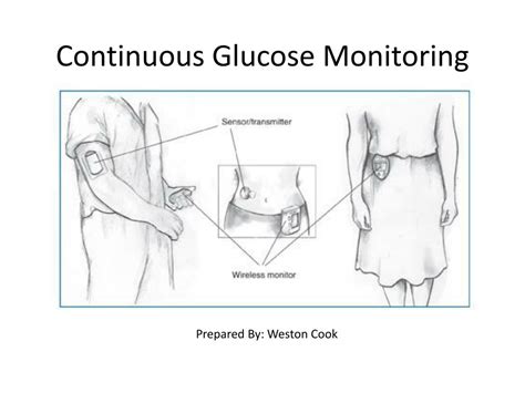PPT Continuous Glucose Monitoring PowerPoint Presentation Free Download ID