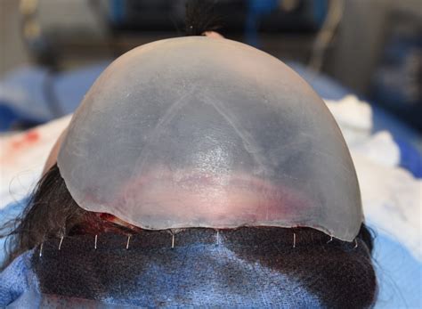 Plastic Surgery Case Study Female Custom Widening Forehead Temporal Implant Explore Plastic
