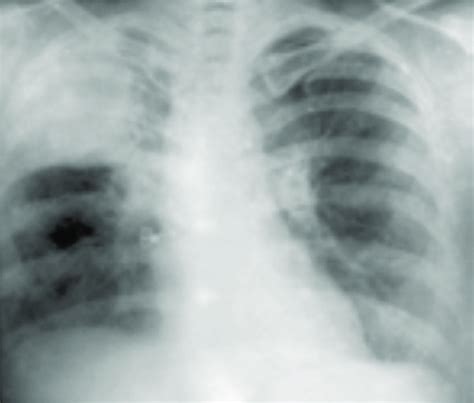 2 No Response After Treatment Download Scientific Diagram