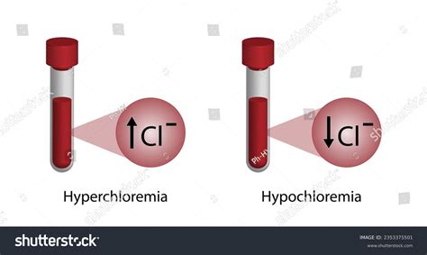Hipercloremia Niveles Elevados De Cloruro Plasmático Vector De Stock Libre De Regalías