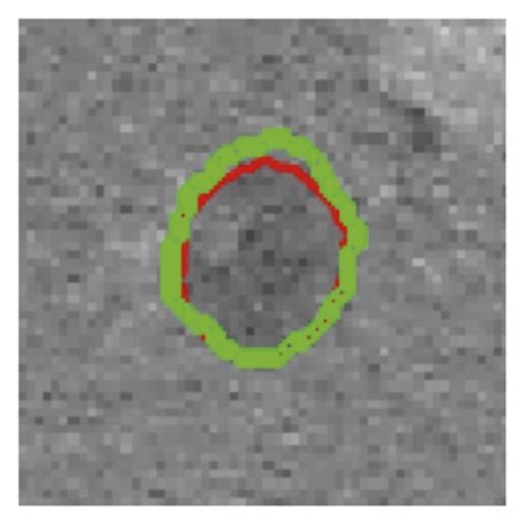 Segmentation Results Obtained By The Proposed Method On The 3dircadb