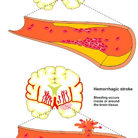 Difference Between Ischemic And Hemorrhagic Stroke Download