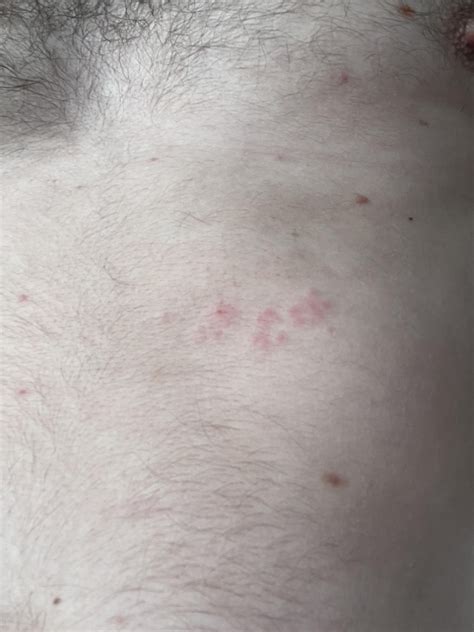 Shingles Bug Bite Cant See A Dermatologist Until Thursday Any Advice Pics Of Day 1 2 And 3