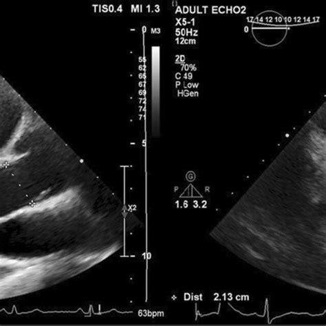 Left Parasternal Short Axis View For Pulmonary Acceleration Time Pat