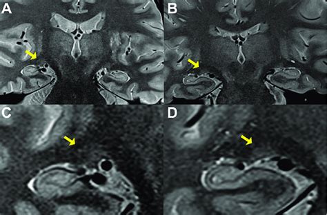 Magnetic Resonance Imaging Scans Showing The Lateral Geniculate Nucleus Download Scientific