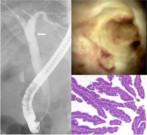 New Digital Cholangiopancreatoscopy For Diagnosis And Therapy Of