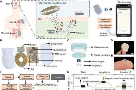 Tech Xplore On Linkedin Tiny Magnetic Implants Enable Wireless Health Monitoring When Paired With…