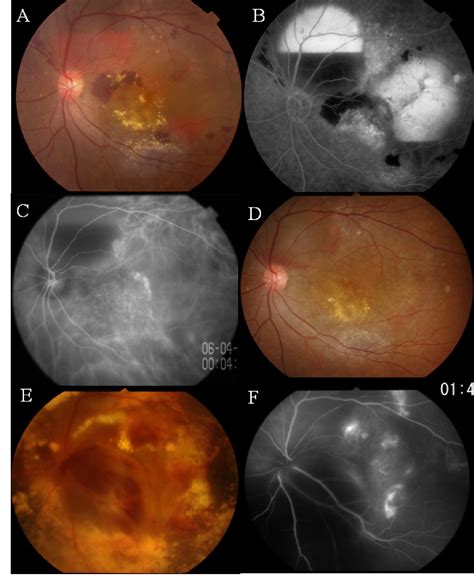 Hypertensive Choroidopathy Semantic Scholar