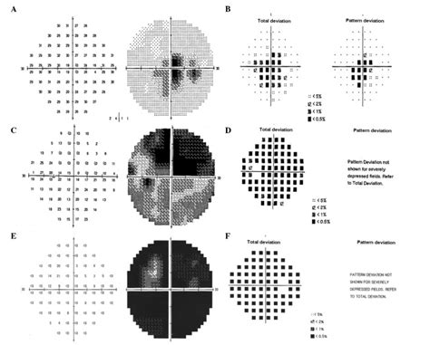 Oct Scanning Visual Field Report Of Three Typical Patients The Central Download Scientific