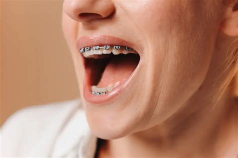 A Complete Guide To Braces Options And Price In Malaysia