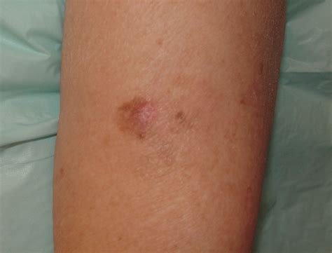 Signs Of Skin Cancer On Lower Leg At Kaitlyn Devine Blog