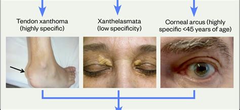 What Is Hypercholesterolaemia Medicine For World