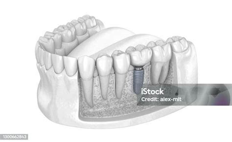 임플란트를 사용하면 전조 된 치아 회복 인간의 치아와 틀니 개념의 의학적으로 정확한 3d 그림 건강관리와 의술에 대한 스톡 사진