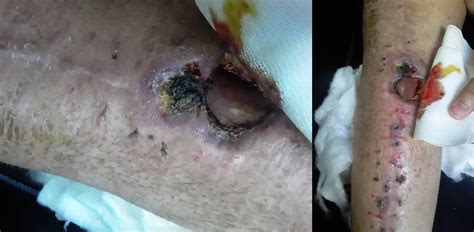 Diphtheria Pseudomembrane Removal