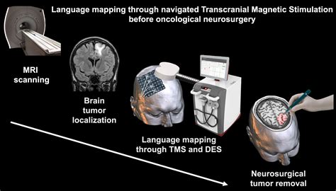 Jpm Free Full Text Preoperative Navigated Transcranial Magnetic Stimulation New Insight For