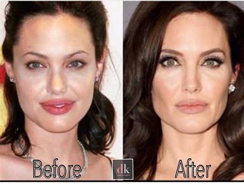 Pin By Tikkotokk On Noses Celebrity Plastic Surgery Kardashian
