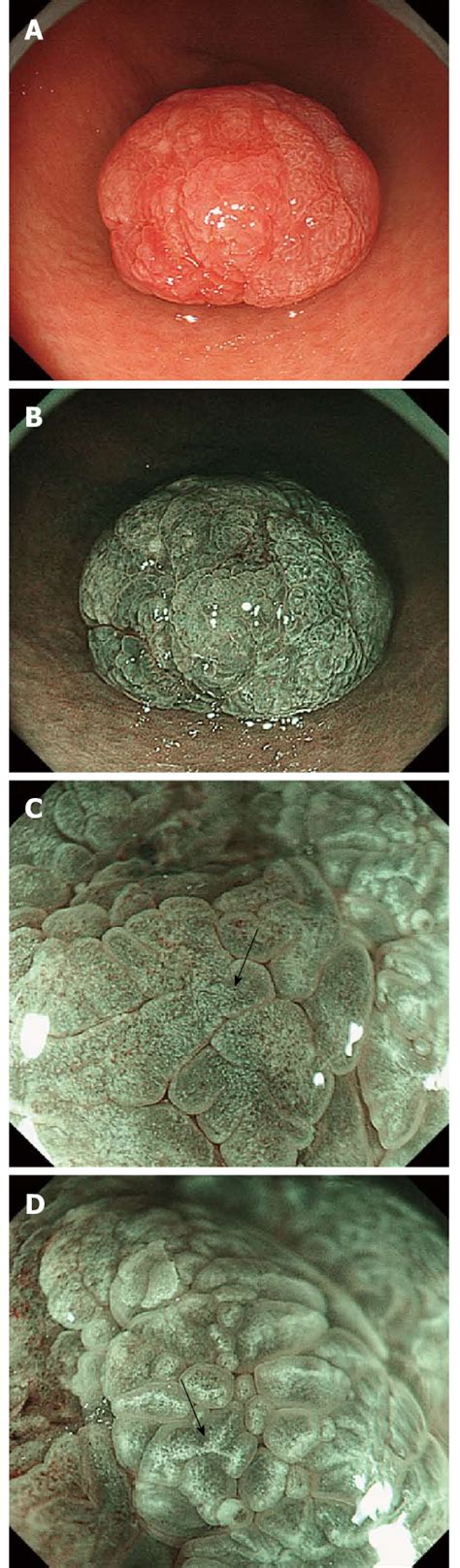 A White Opaque Substance Positive Gastric Hyperplastic Polyp Is Shown