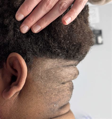 Male Occipital Scalp Roll Side 1 Dr Barry Eppley Explore Plastic Surgery