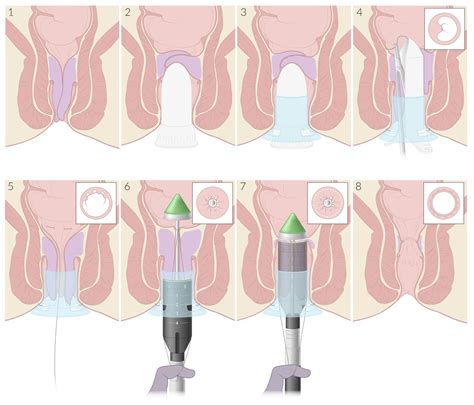 Rectal Prolapse Vs Hemorrhoid