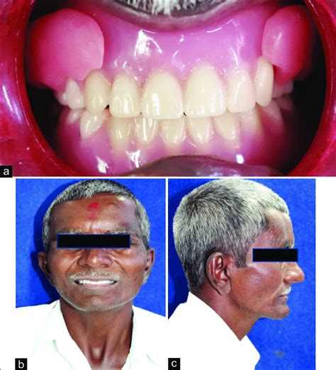 A Prosthesis In Situ B Post Operative Frontal View C