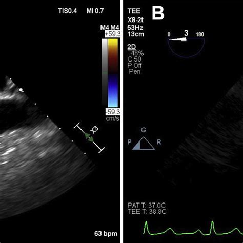 Tee Images Demonstrating Intact Interatrial Septum And Thrombus On Download Scientific Diagram