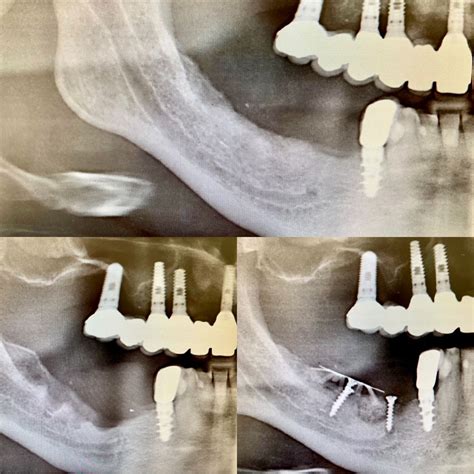 Jawbone Augmentation With Xenograft Material Reconstructive Bone Grafting Dr Marco Cardinali