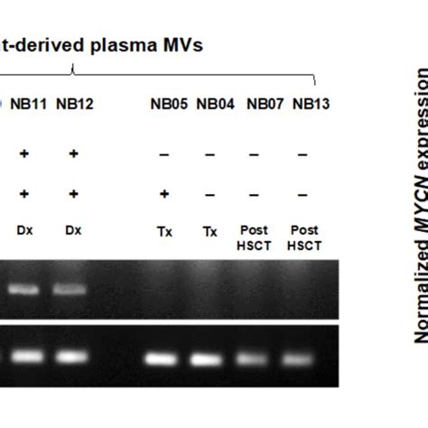 Mycn Mv Detection In Patient Derived Bone Marrow Plasma Specimens Mvs