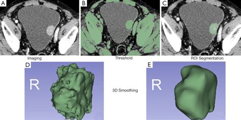 Semi Automatic Three Dimensional Segmentation Of Bladder Tumor And The Download Scientific