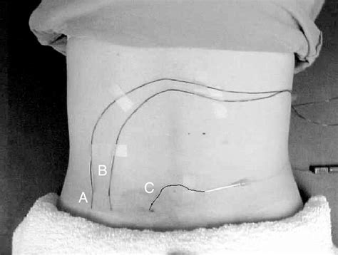 Intramuscular And Skin Interface Thermocouple Placement A Skin Download Scientific Diagram