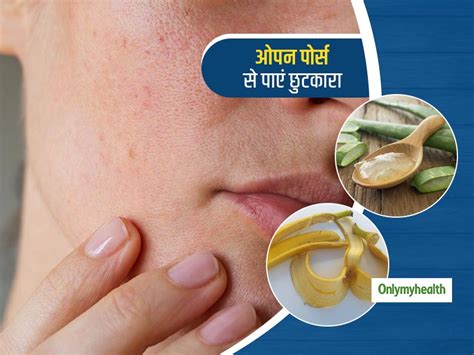 Home Remedies For Open Pores चेहरे के ओपन पोर्स से छुटकारा पाना है तो